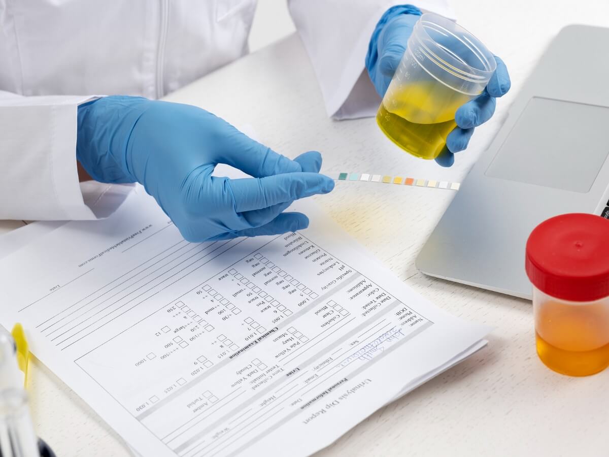 Urobilinogen in Urine: Test Procedure, Causes, Symptoms, and Treatment