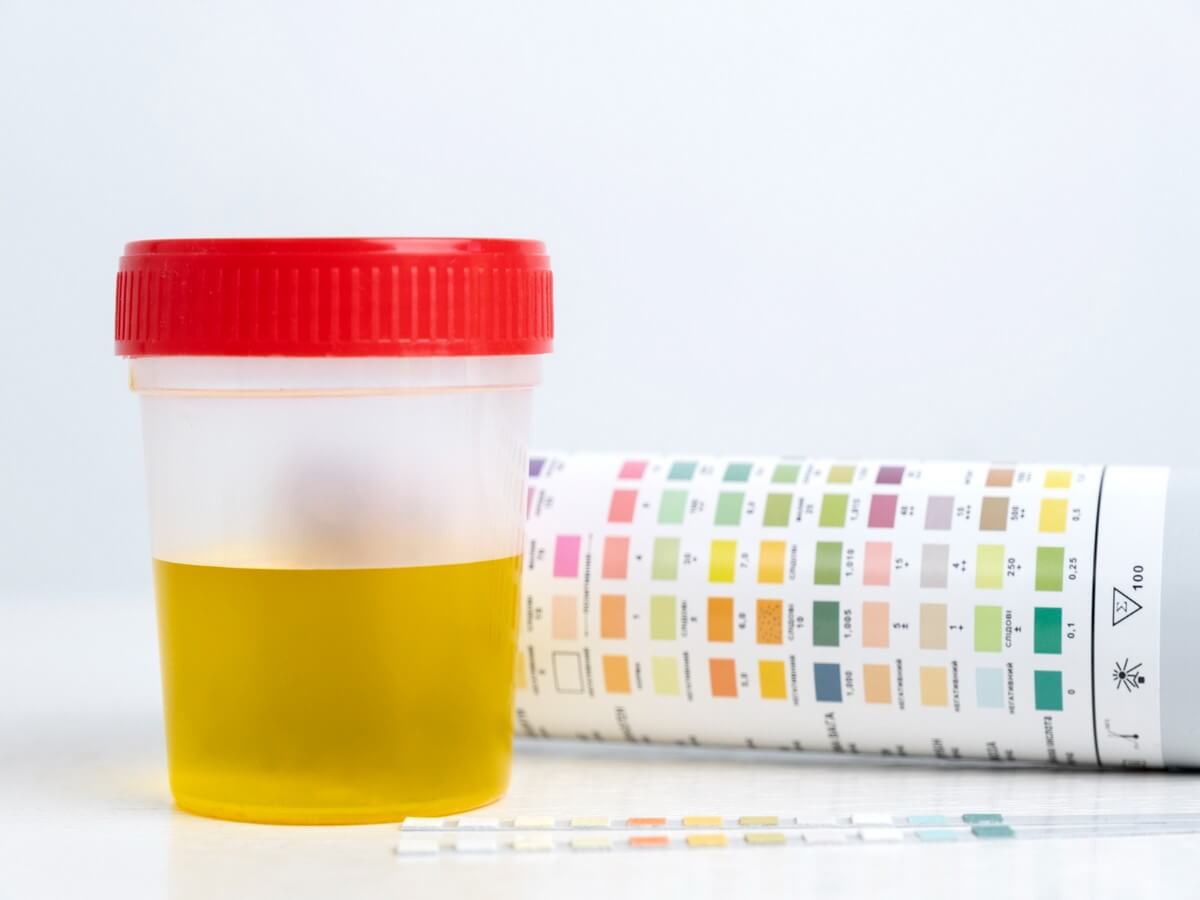 Urinalysis: Physical Examination and Interpretation