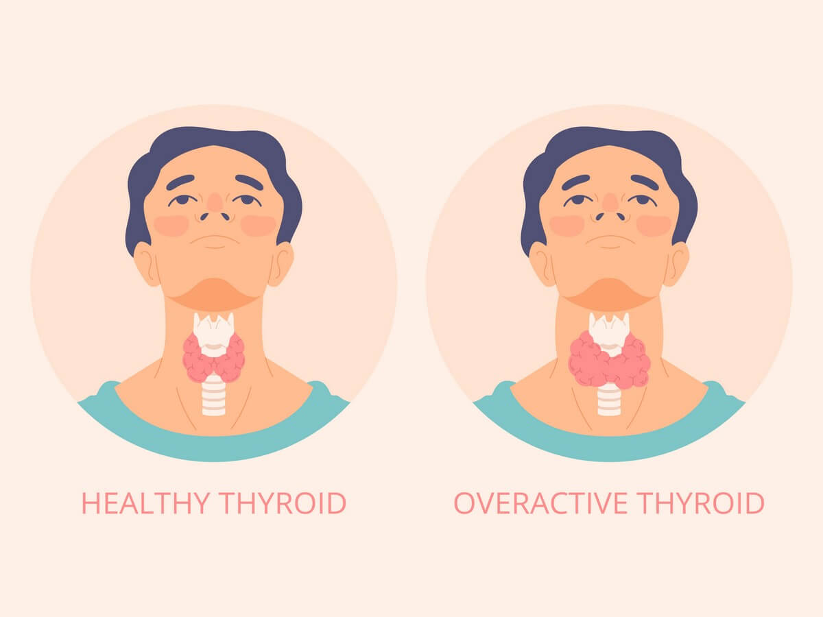 Disorders of Thyroid Gland: Hypothyroidism & Hyperthyroidism