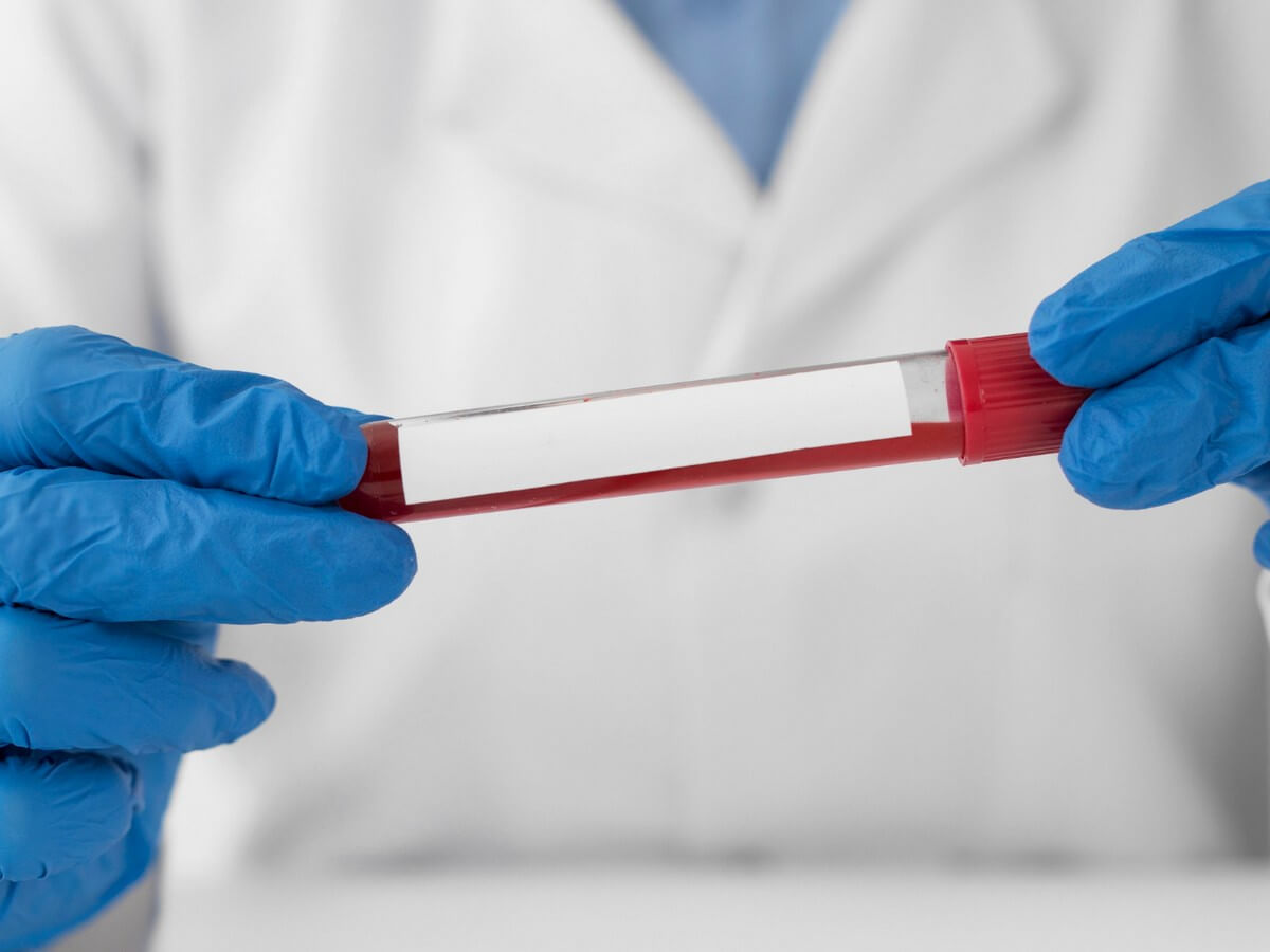 Bilirubin: Total, Direct and Indirect Bilirubin (Different Types of ...