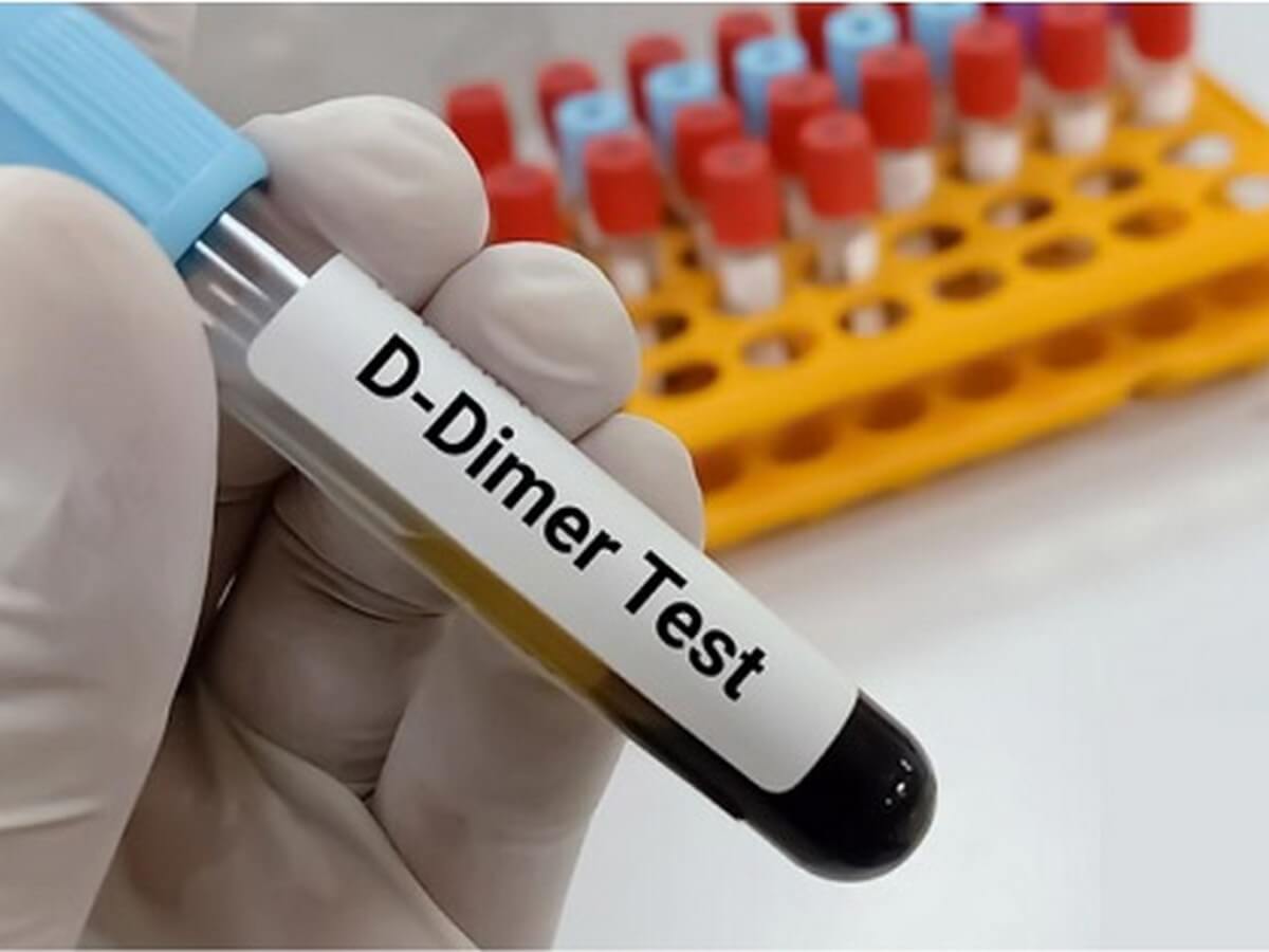D Dimer Test and Its Clinical Significance